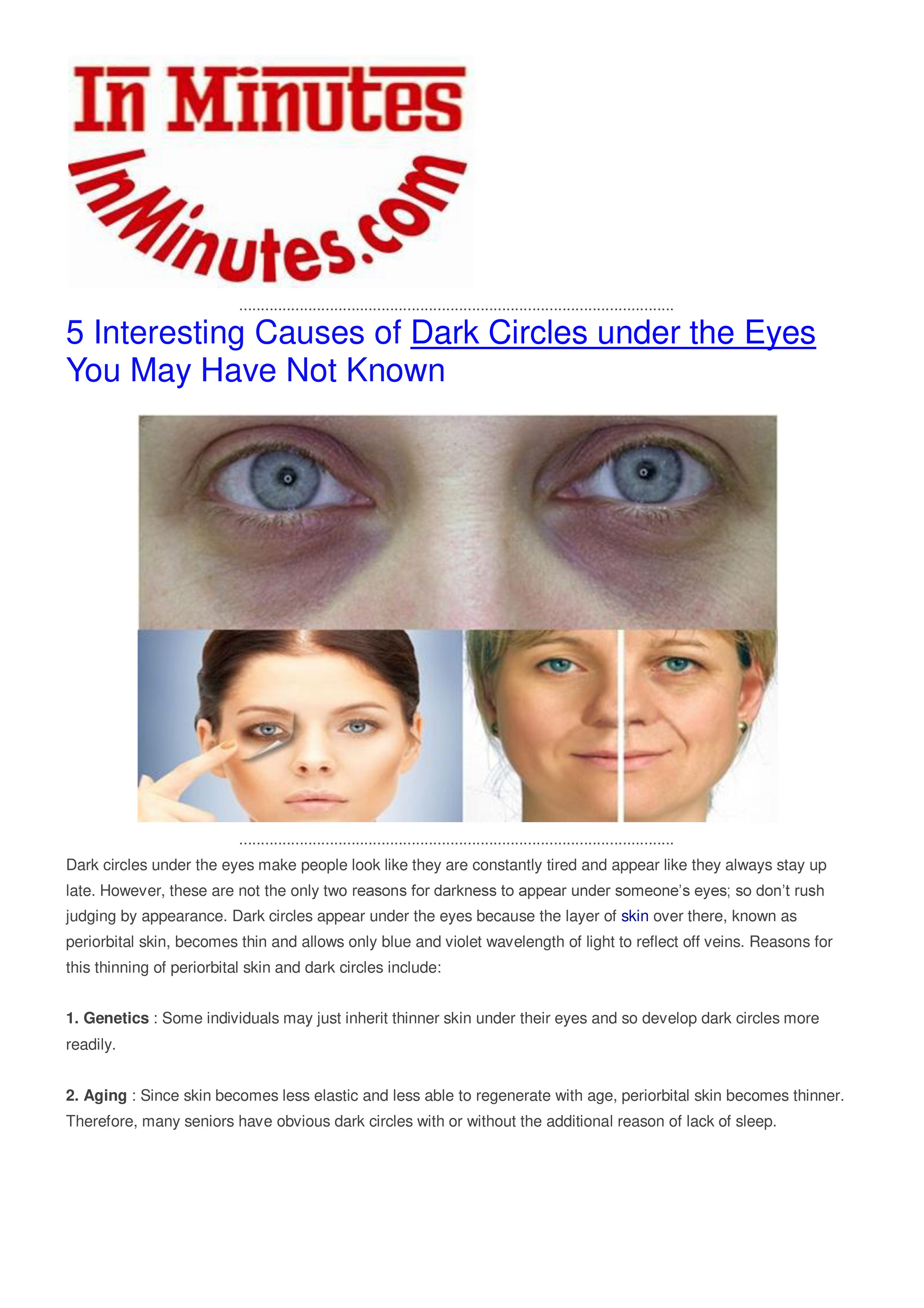 Causes Of Severe Dark Circles Under Eyes Quora Infoupdate Org