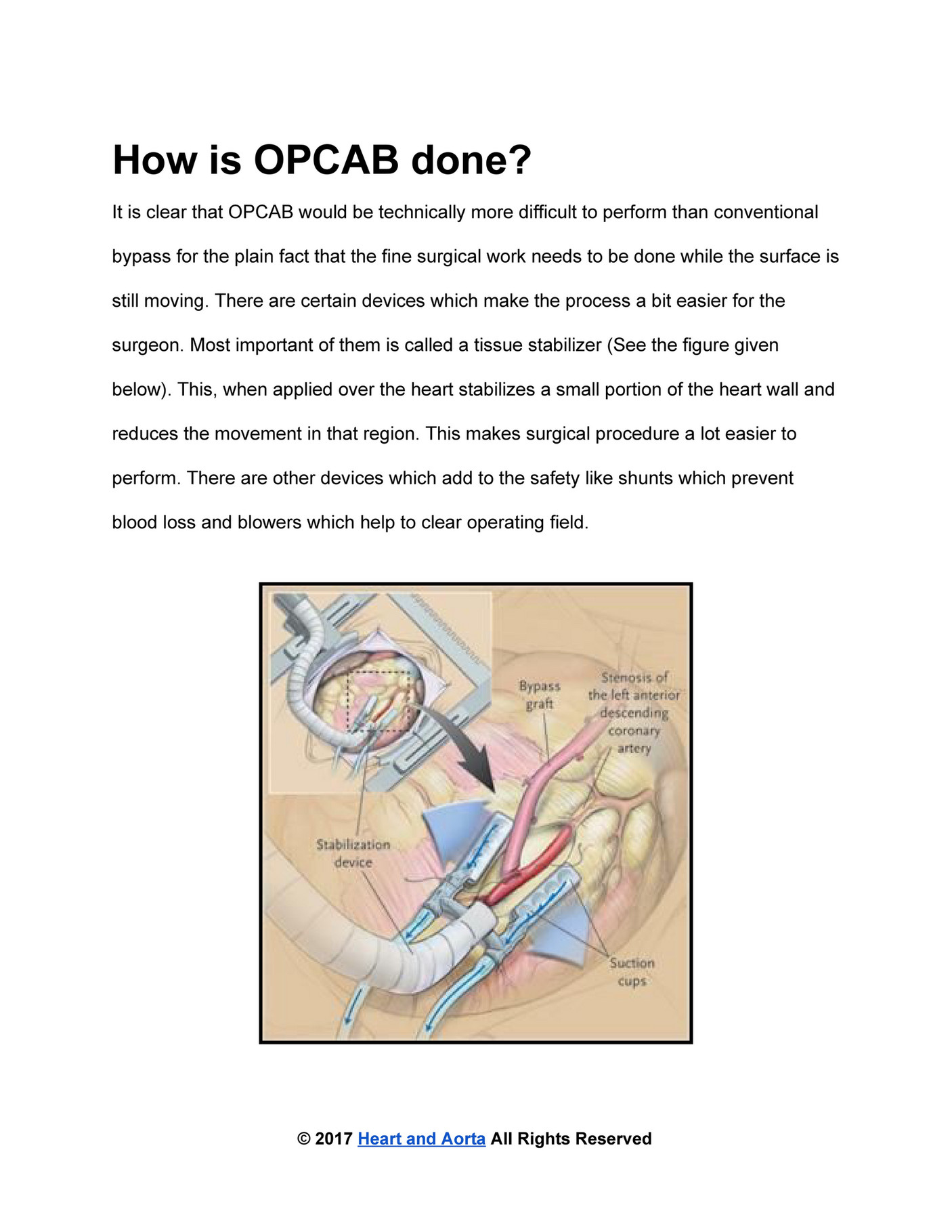 Heart and Aorta - How is OPCAB done? - Page 1 - Created with Publitas.com