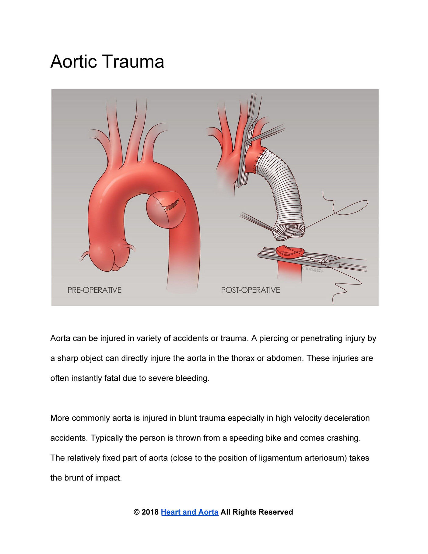 Heart and Aorta - Aortic Trauma - Page 2 - Created with Publitas.com